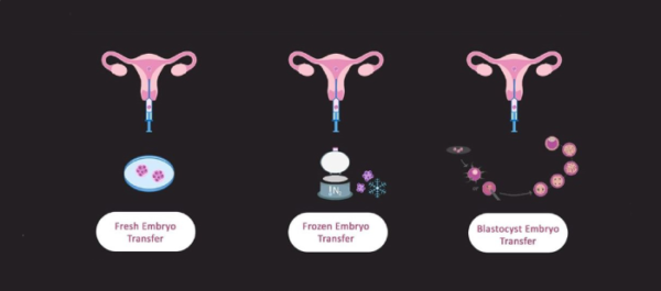 Embryo transfer: What is it? Why It Is Used